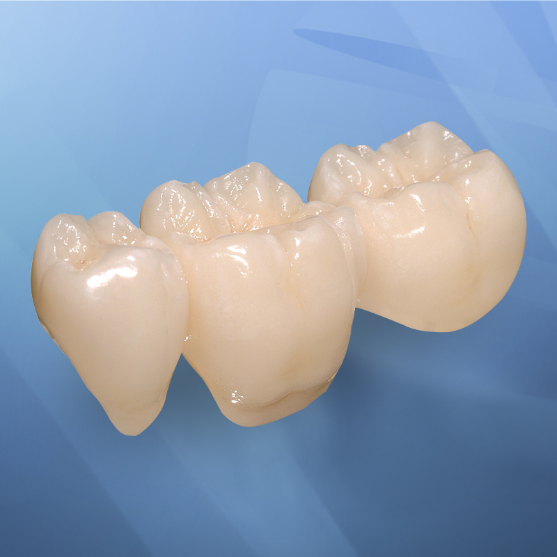 IPS e.max® Crowns | Elegant Lab